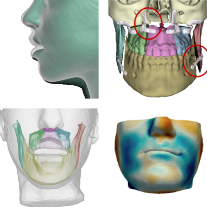 Soft-Tissue Simulation for Computational Planning of Orthognathic ...